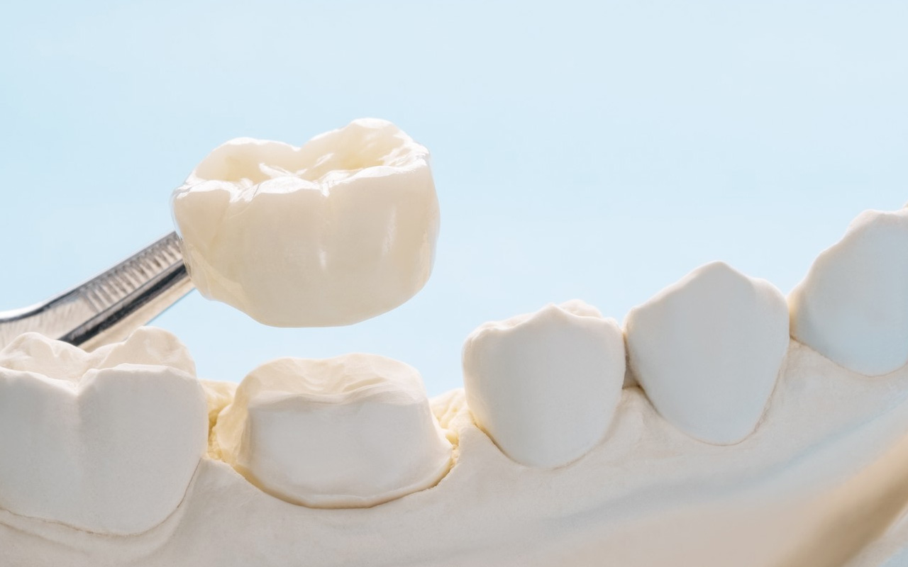 Types of Dental Porcelain Crowns: Which One is the Best?