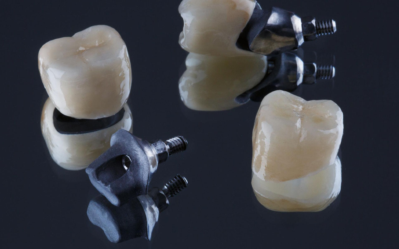 Different Types of Dental Implant Crowns | Long Lake Family Dentistry