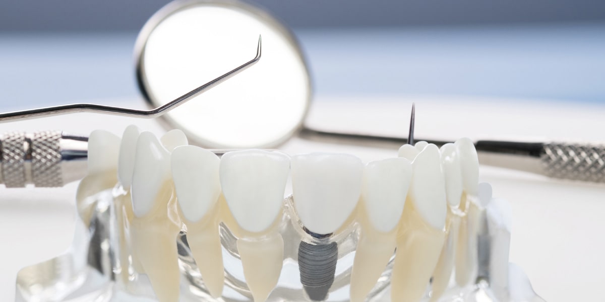 Single Tooth Implants in New Brighton, Near Minneapolis, MN